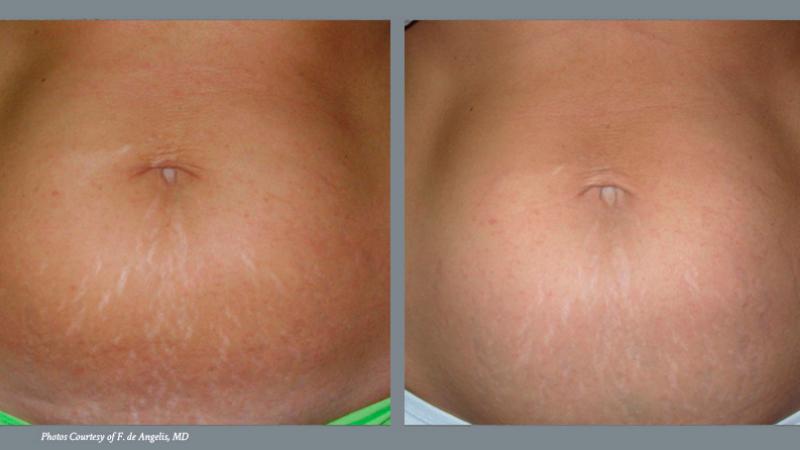 Stretch Mark Reduction St Peter s Health stretch-mark-reduction-st-peter-s-health